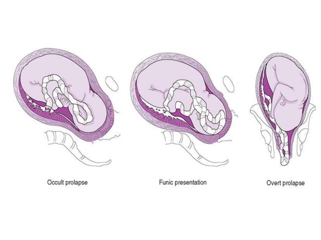 Umbilical cord prolapse | PPT