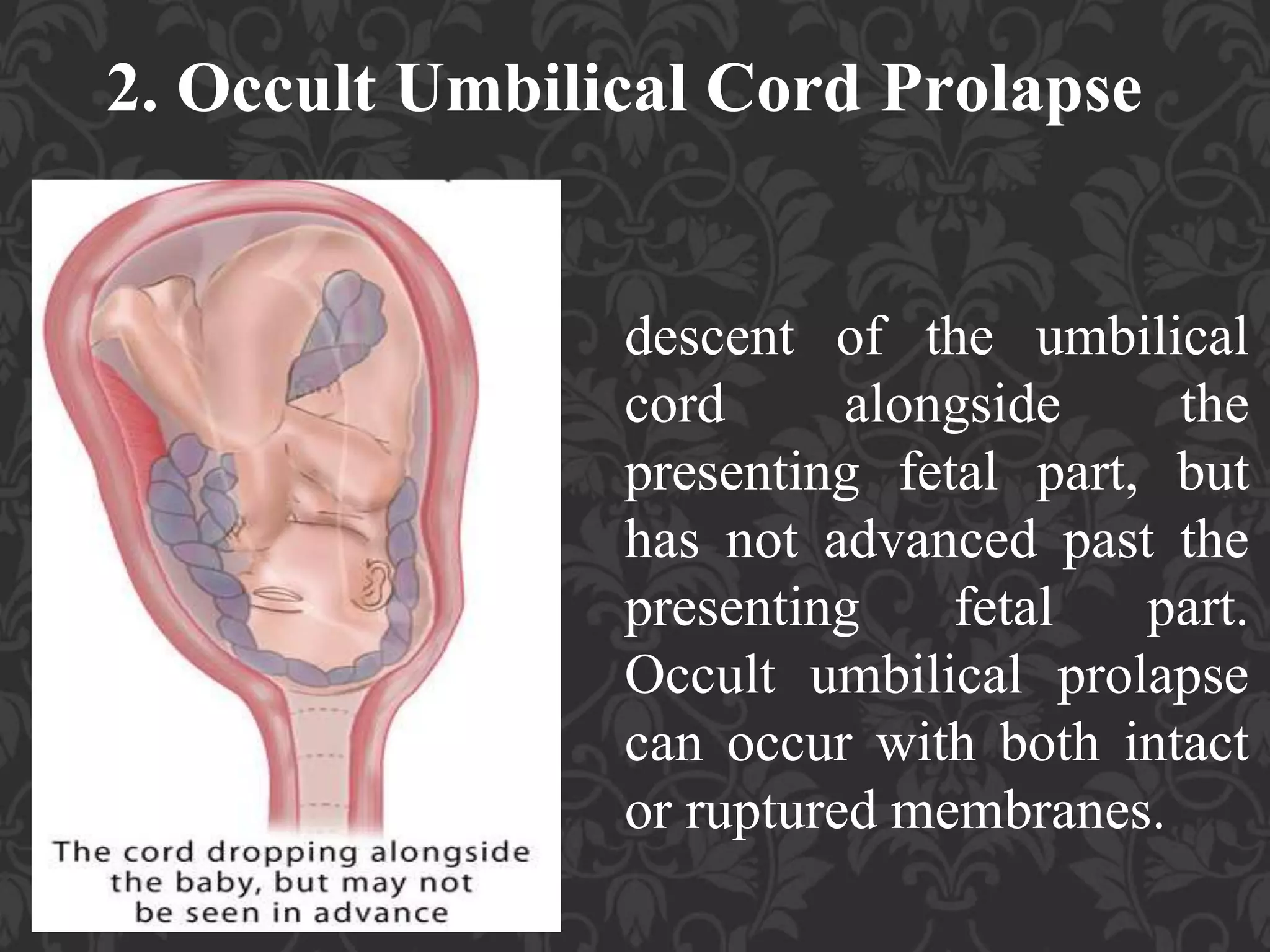 Umbilical Cord Prolapse, Presented By Mohammed Haroon Rashid | PPTX
