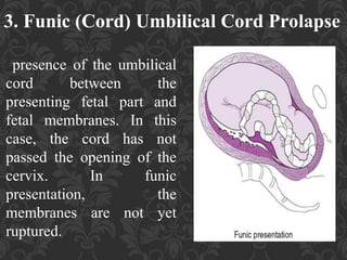 Umbilical Cord Prolapse, Presented By Mohammed Haroon Rashid | PPTX