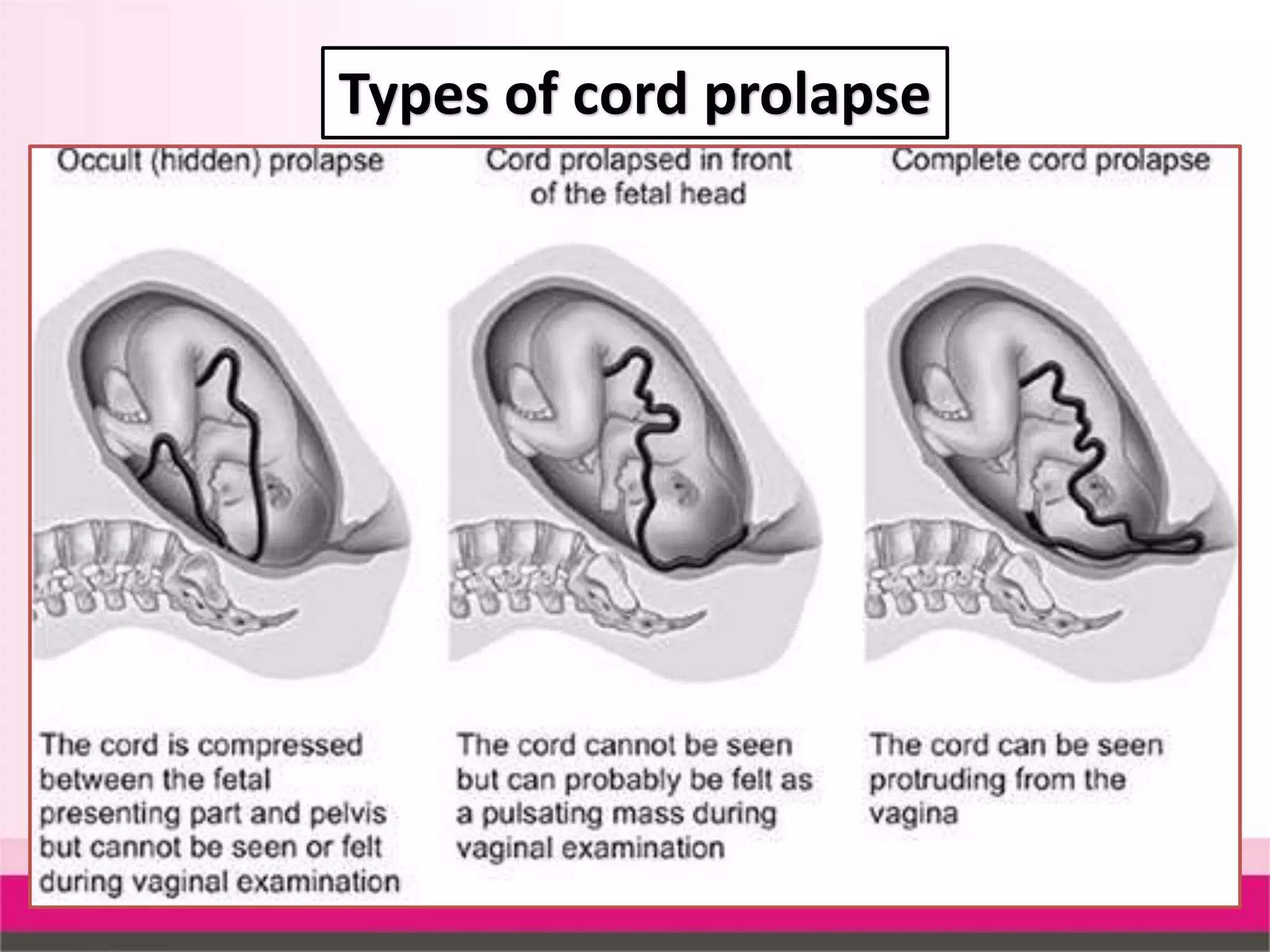Umbilical cord prolapse by dr alka mukherjee dr apurva mukherjee nagpur ...