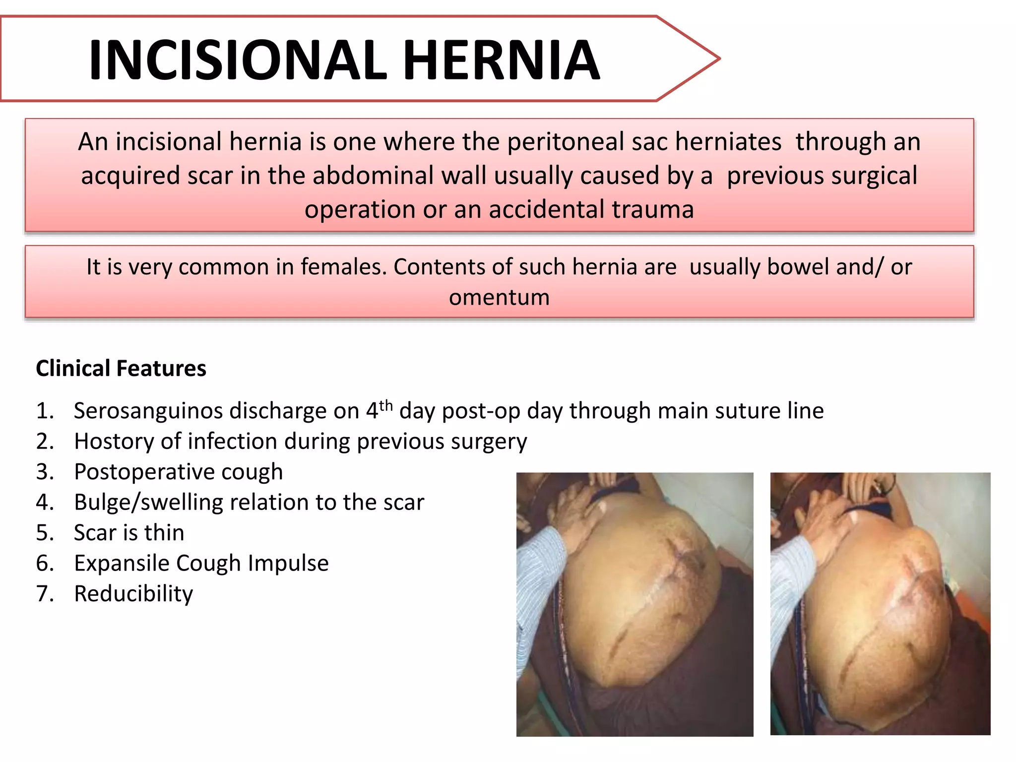 Umbilical hernia | PPTX