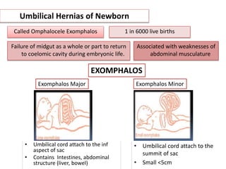 Umbilical hernia | PPTX