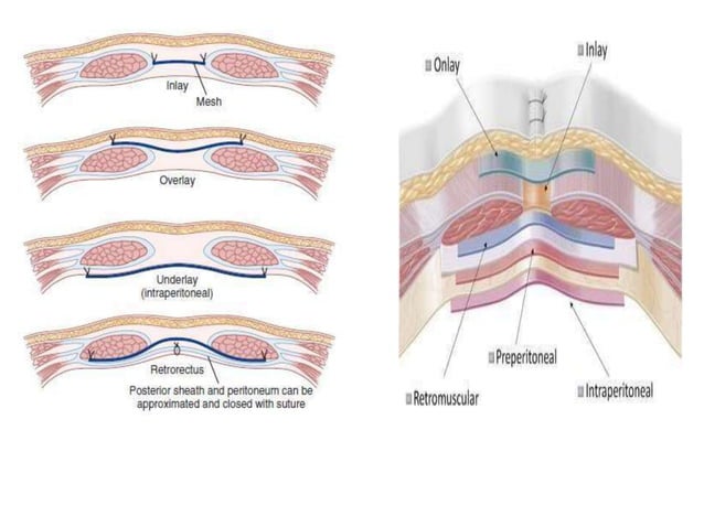 Umbilical hernia | PPT