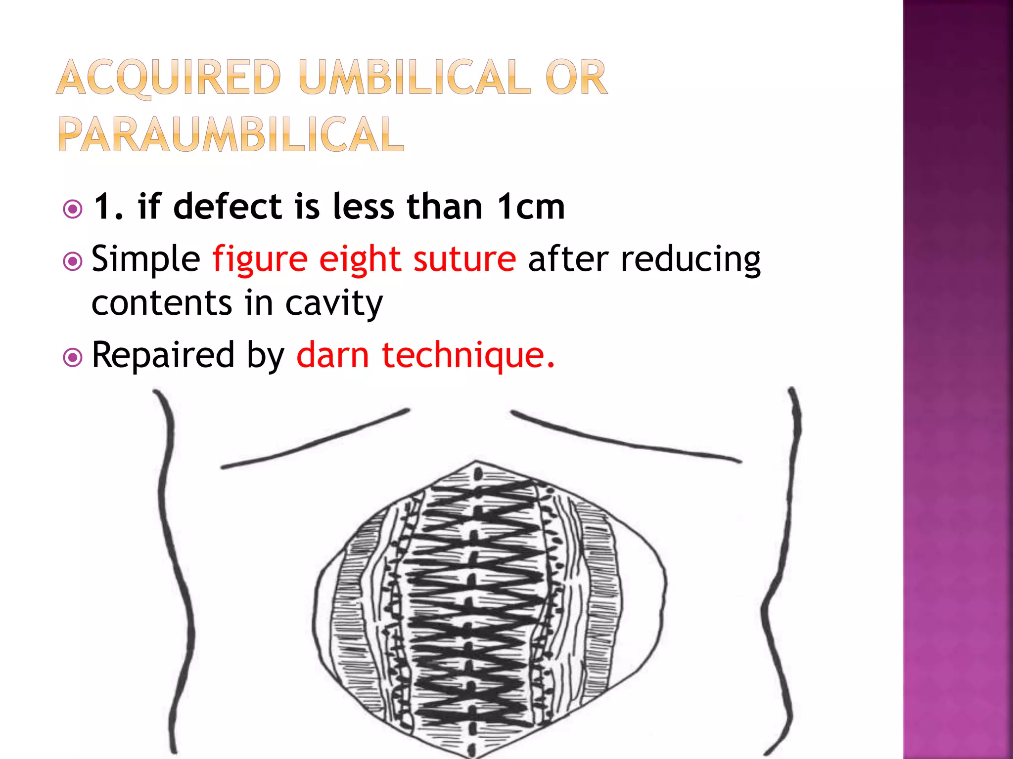 Umbilical hernia by Dr. kiran maindale | PPTX