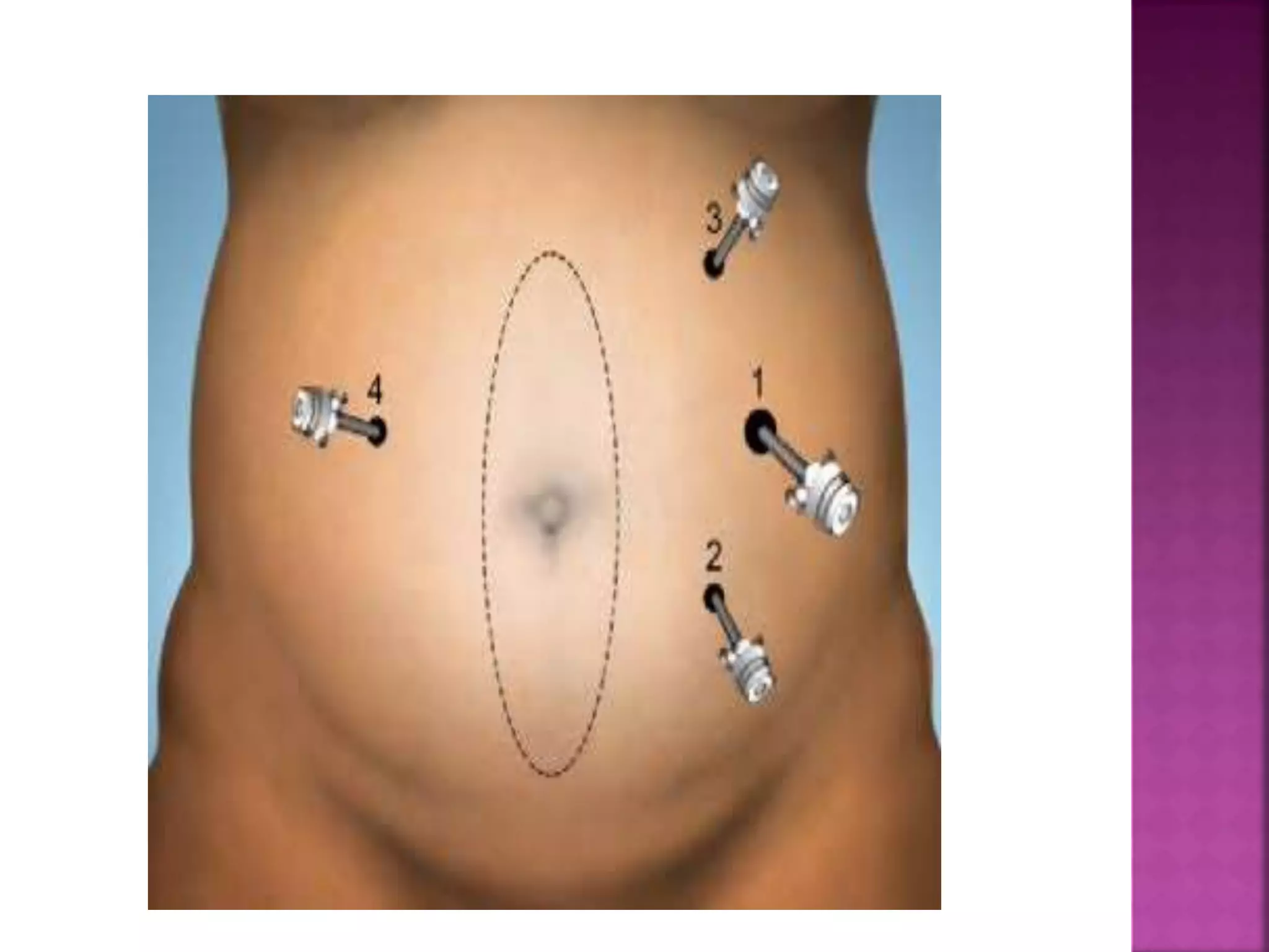 Umbilical Hernia By Dr Kiran Maindale Ppt