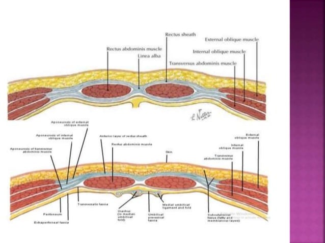 Umbilical hernia by Dr. kiran maindale | PPTX | Pregnancy ...