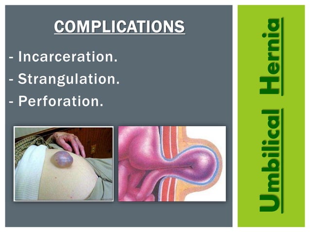 Umbilical hernia | PPTX | Pregnancy | Reproductive Health