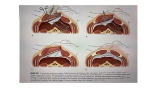 Umbilical Hernia- A Comprehensive presentation on various surgical ...