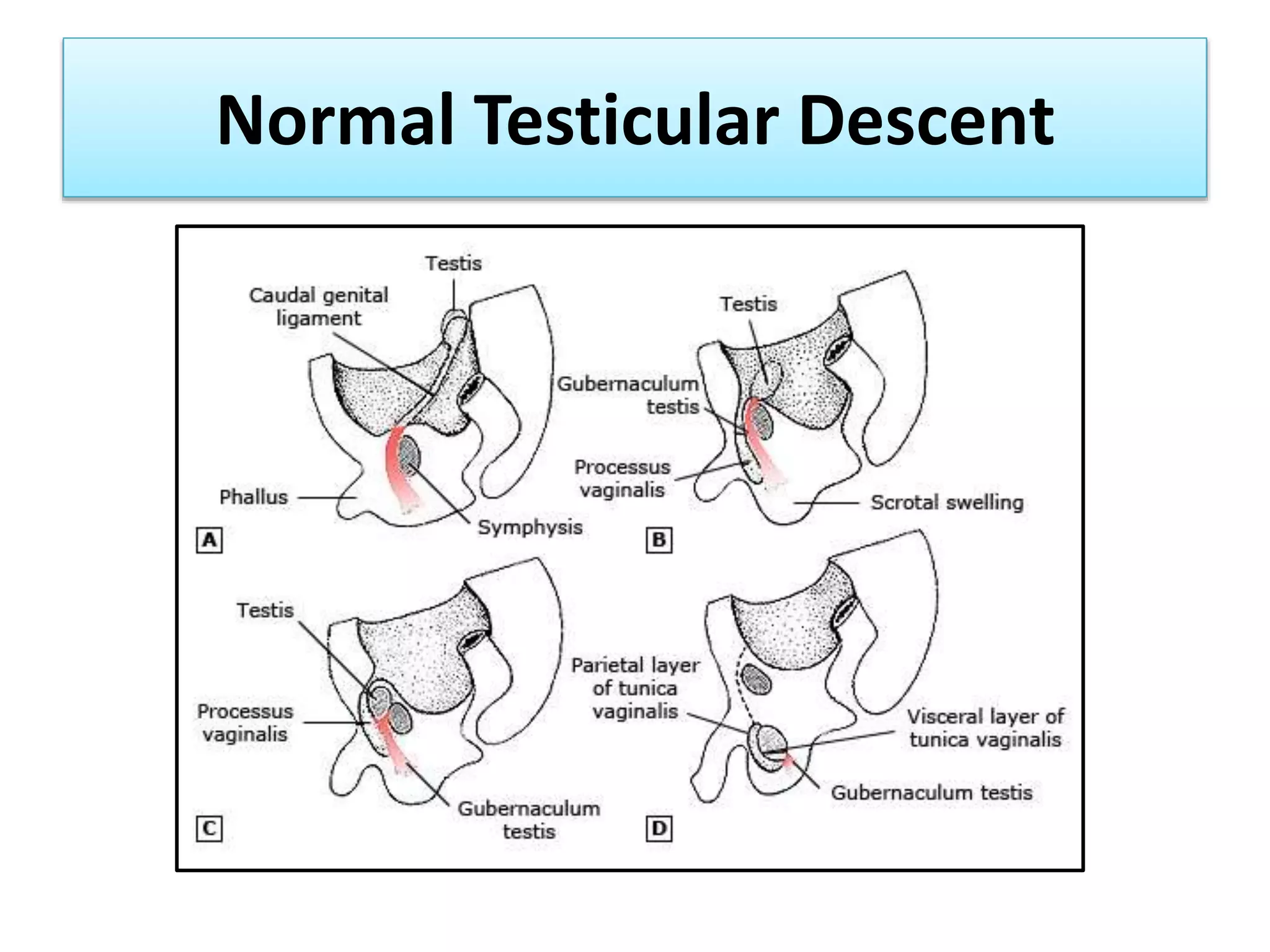 Umbilical hernia ,undescended testis | PPTX
