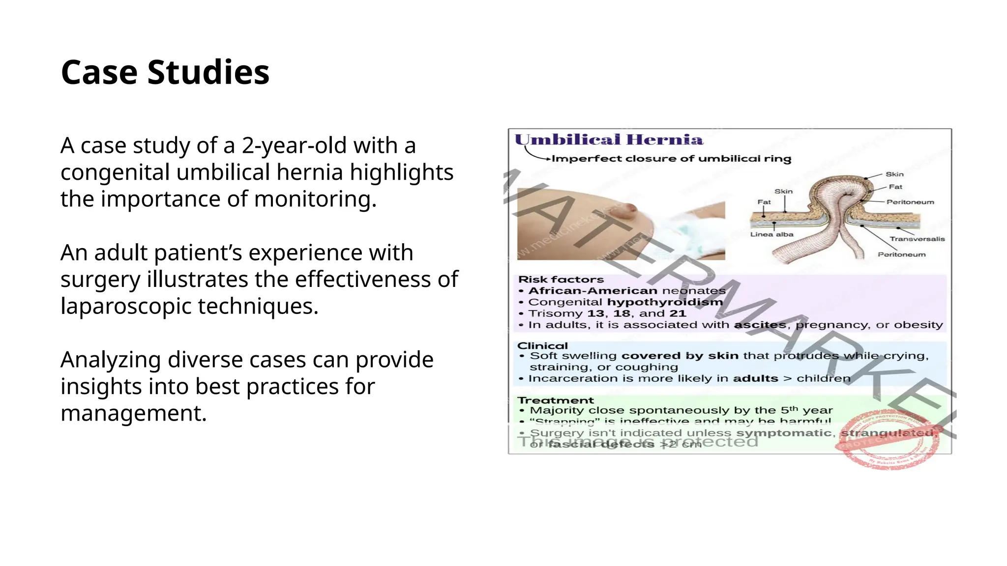 Umbilicalis Hernia - about hernia of umblical | PPTX
