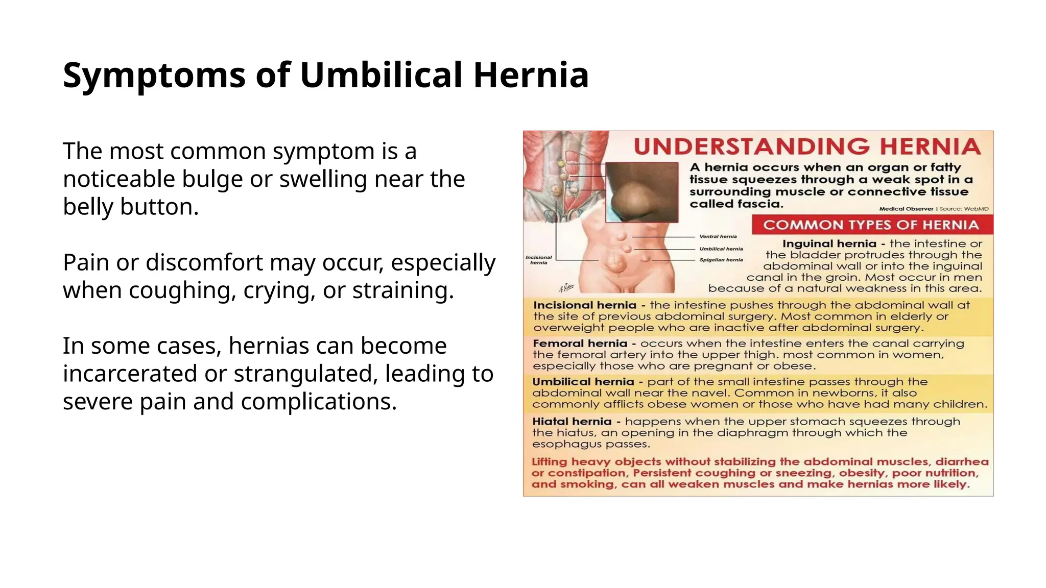Umbilicalis Hernia - about hernia of umblical | PPTX