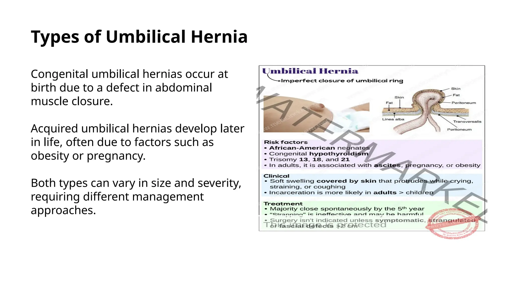 Umbilicalis Hernia - about hernia of umblical | PPTX