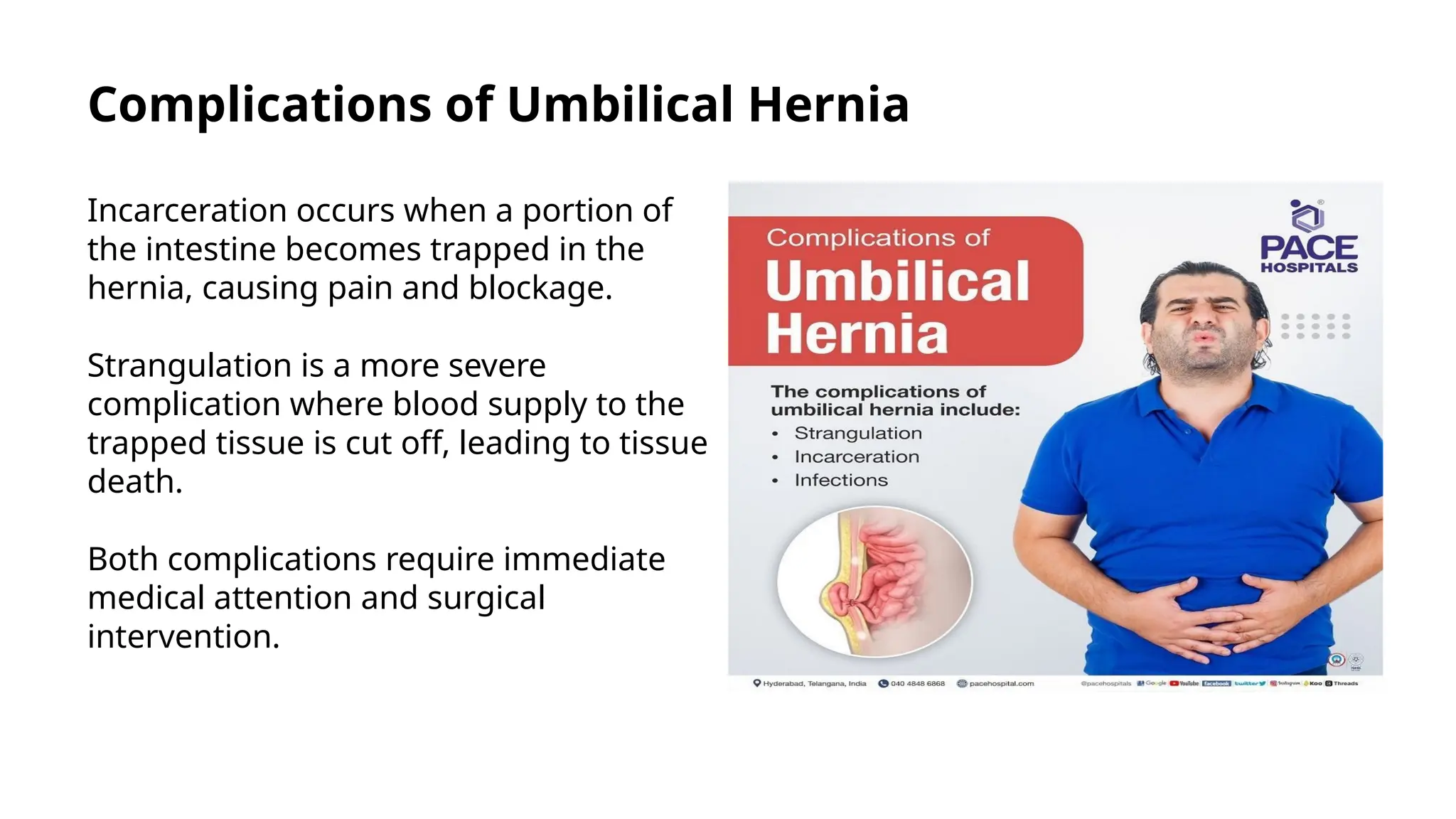 Umbilicalis Hernia - about hernia of umblical | PPTX