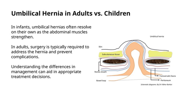 Umbilicalis Hernia - about hernia of umblical | PPTX | Pregnancy ...