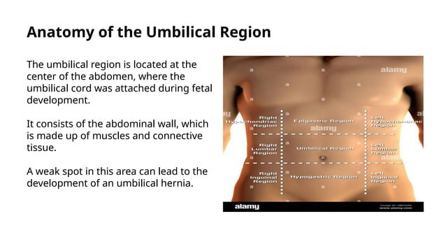 Umbilicalis Hernia - about hernia of umblical | PPT