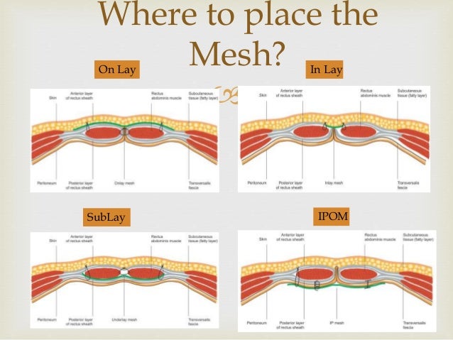 Umbilical & Other Abdominal Hernia