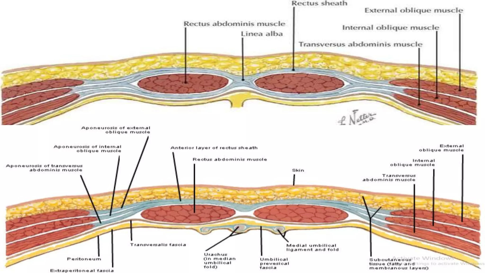Umbilical Paraumbilical Hernia- Saral | PPTX