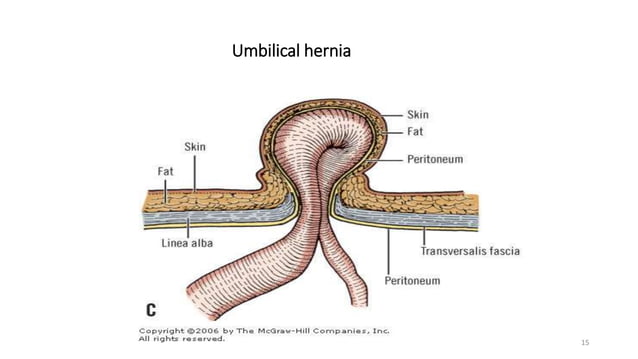 Umbilical Paraumbilical Hernia- Saral | PPTX