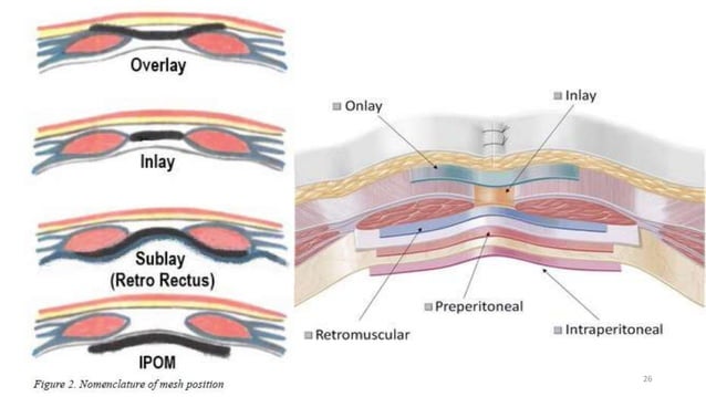 Umbilical Paraumbilical Hernia- Saral | PPTX
