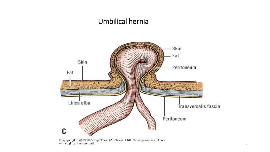 Umbilical Paraumbilical Hernia Saral
