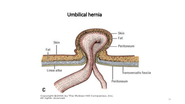 Umbilical Paraumbilical Hernia- Saral