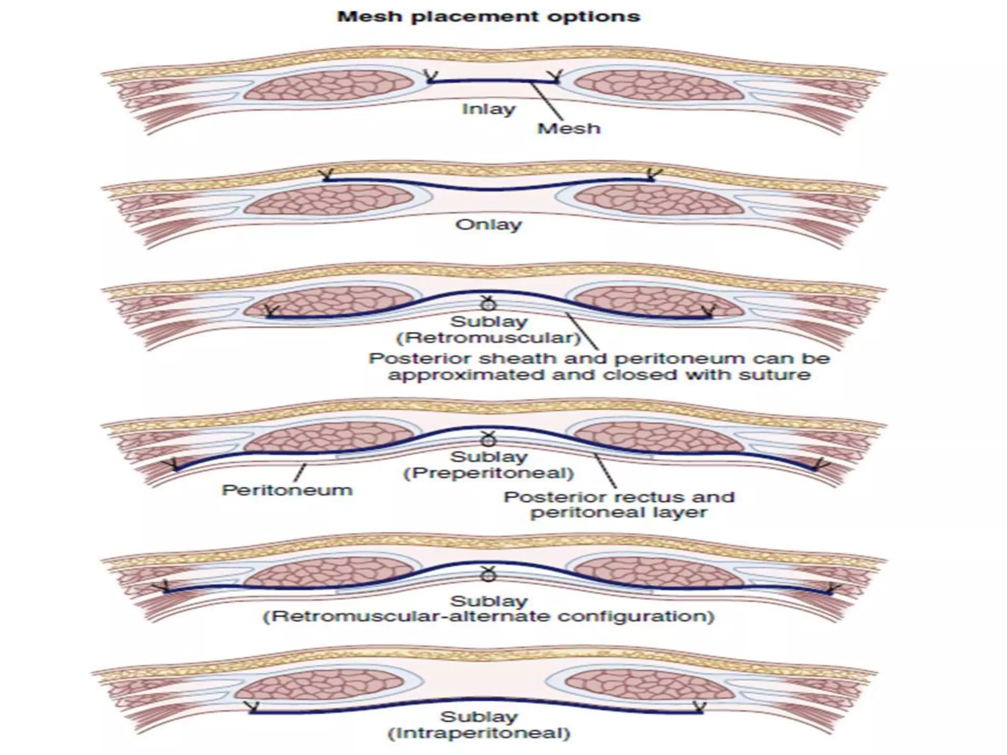 Umbilical, paraumbilical, incisional hernia revision | PPTX