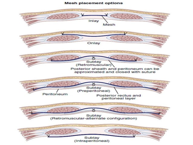 Umbilical, paraumbilical, incisional hernia revision | PPTX