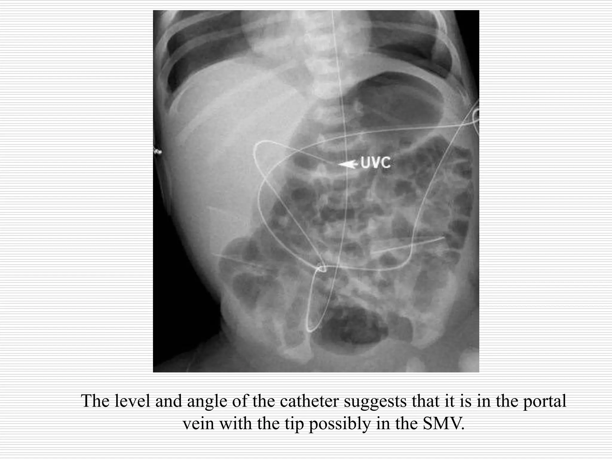 Neonatal Umbilical Venous Catherization Radiology | PPT