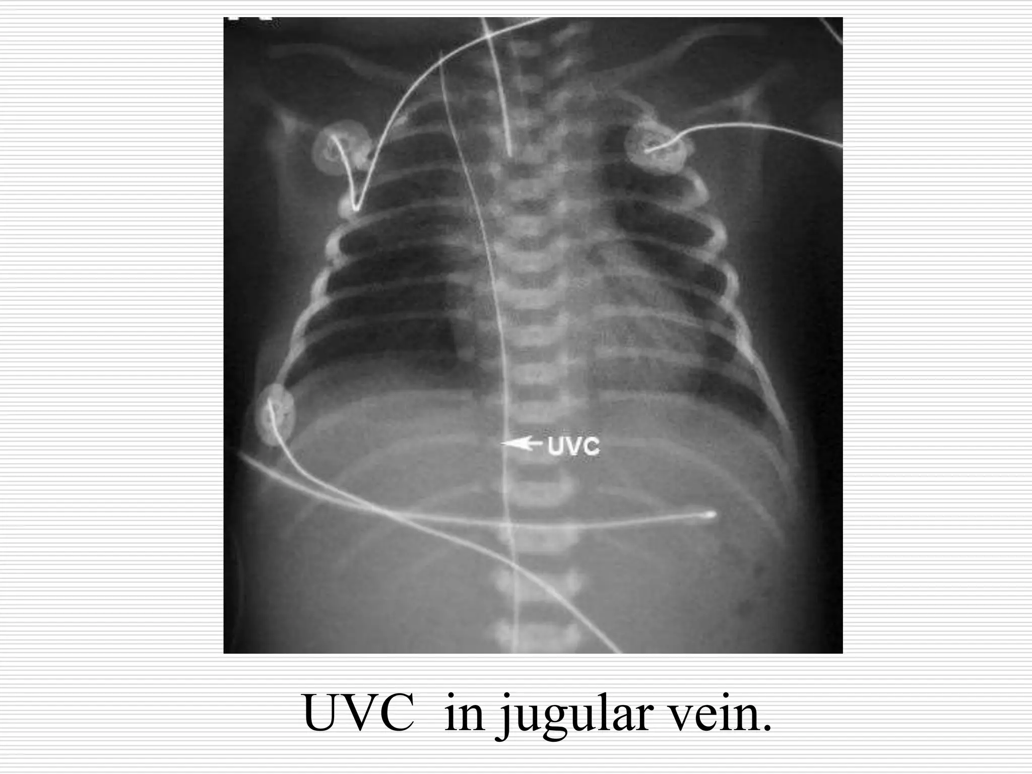 Neonatal Umbilical Venous Catherization Radiology | PPT
