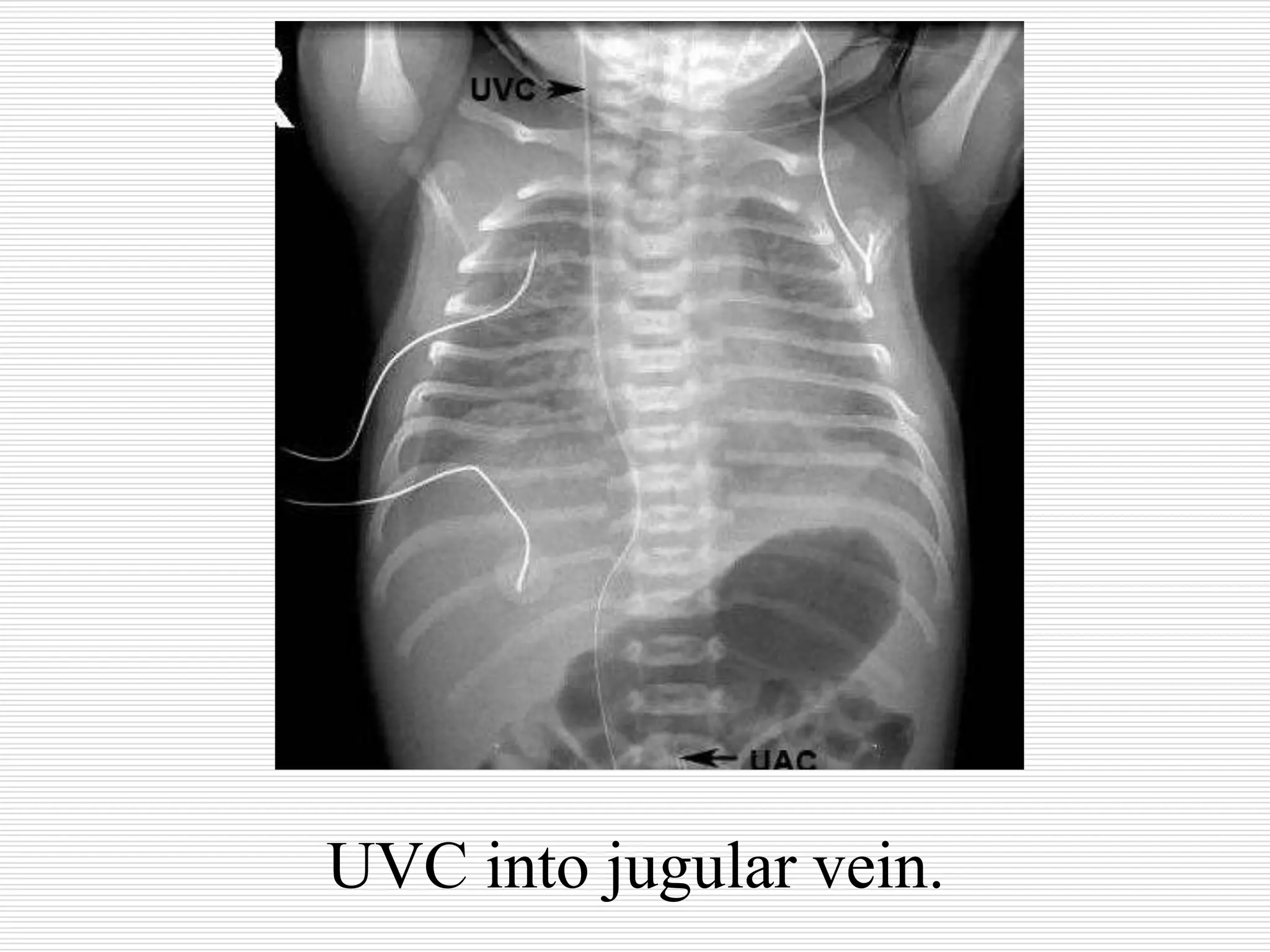 Neonatal Umbilical Venous Catherization Radiology | PPT