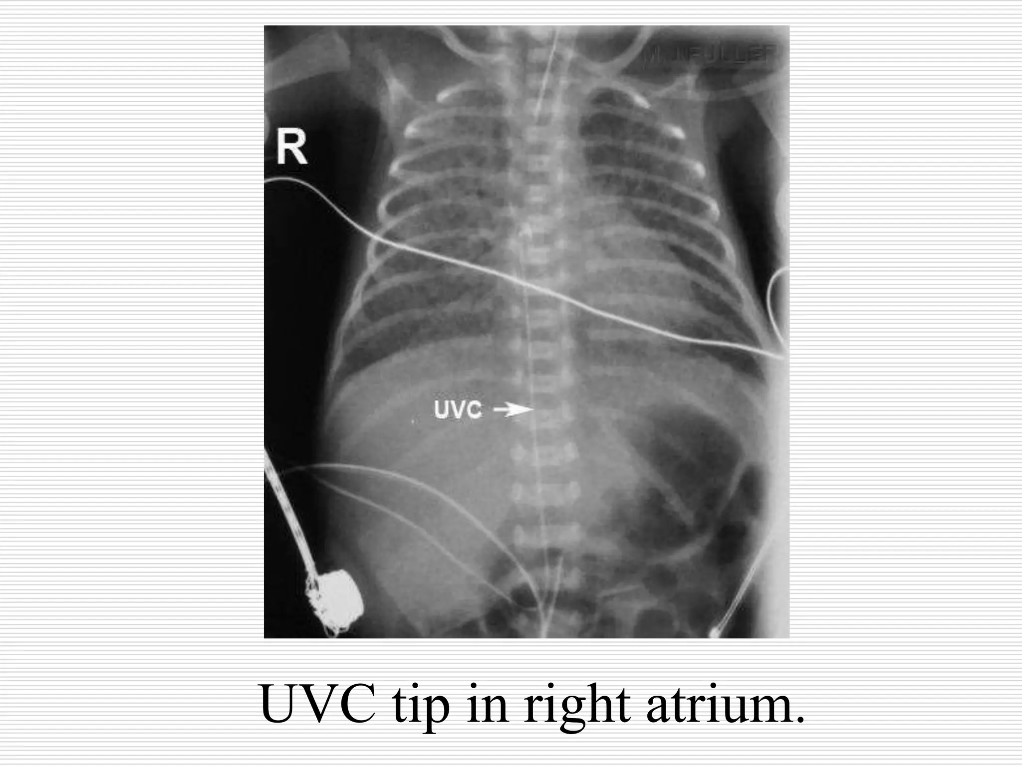 Neonatal Umbilical Venous Catherization Radiology | PPT