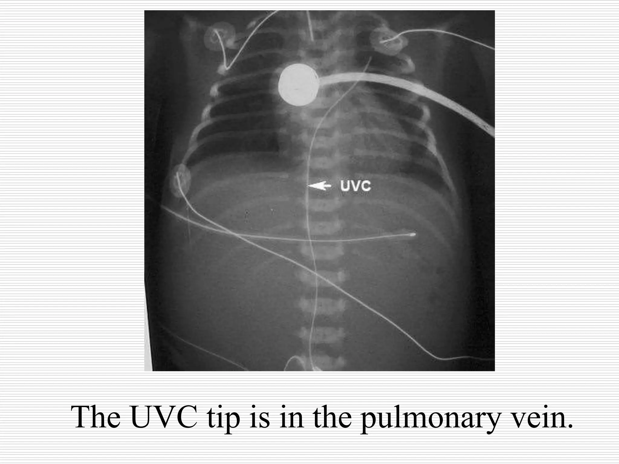 Neonatal Umbilical Venous Catherization Radiology | PPT