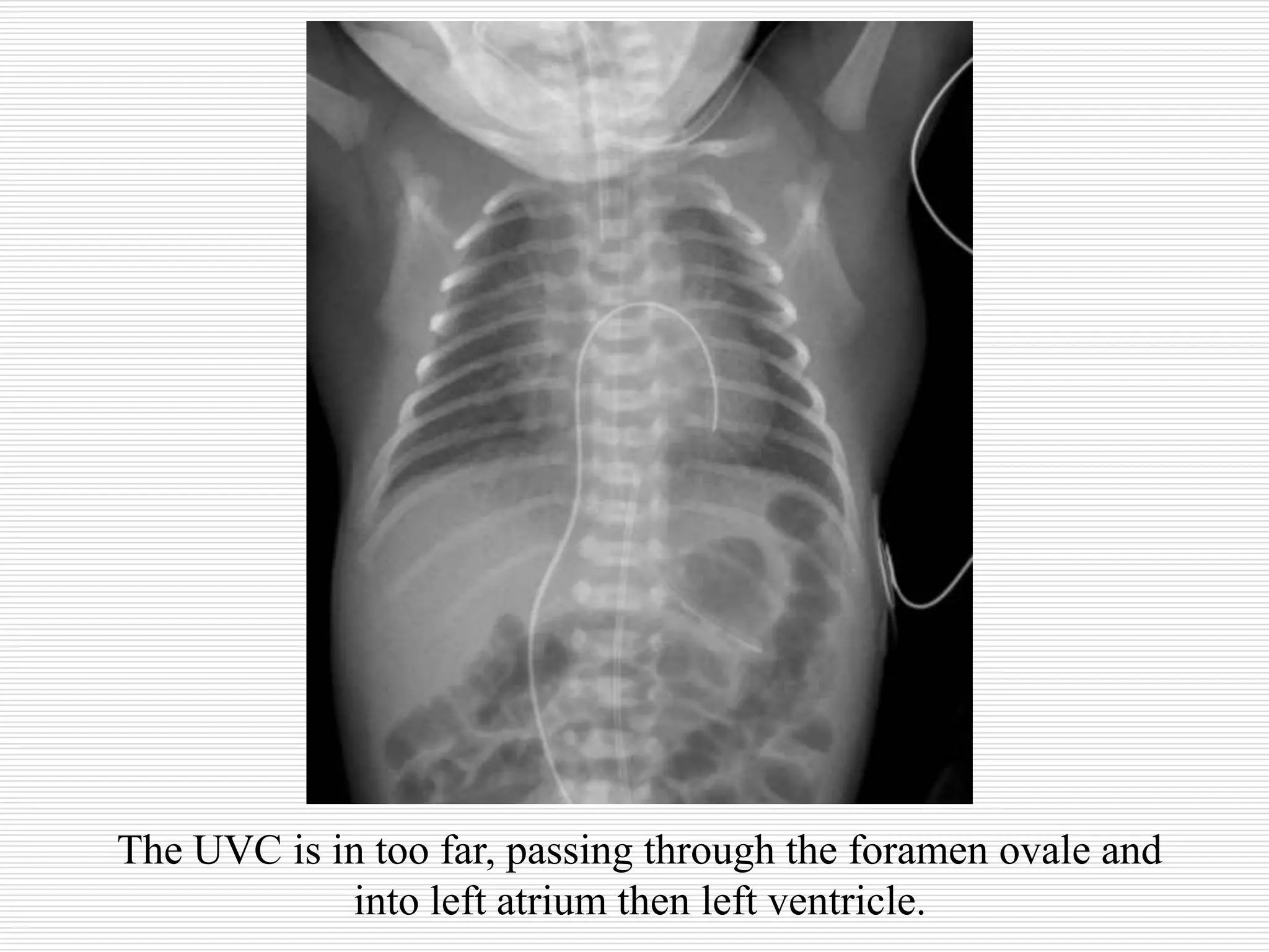 Neonatal Umbilical Venous Catherization Radiology | PPT