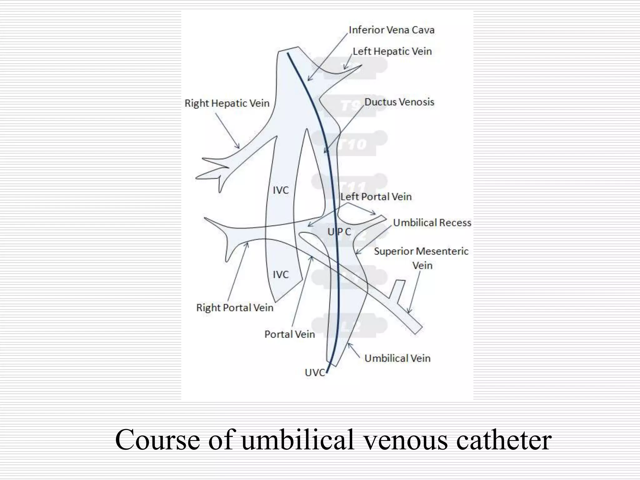 Neonatal Umbilical Venous Catherization Radiology | PPT