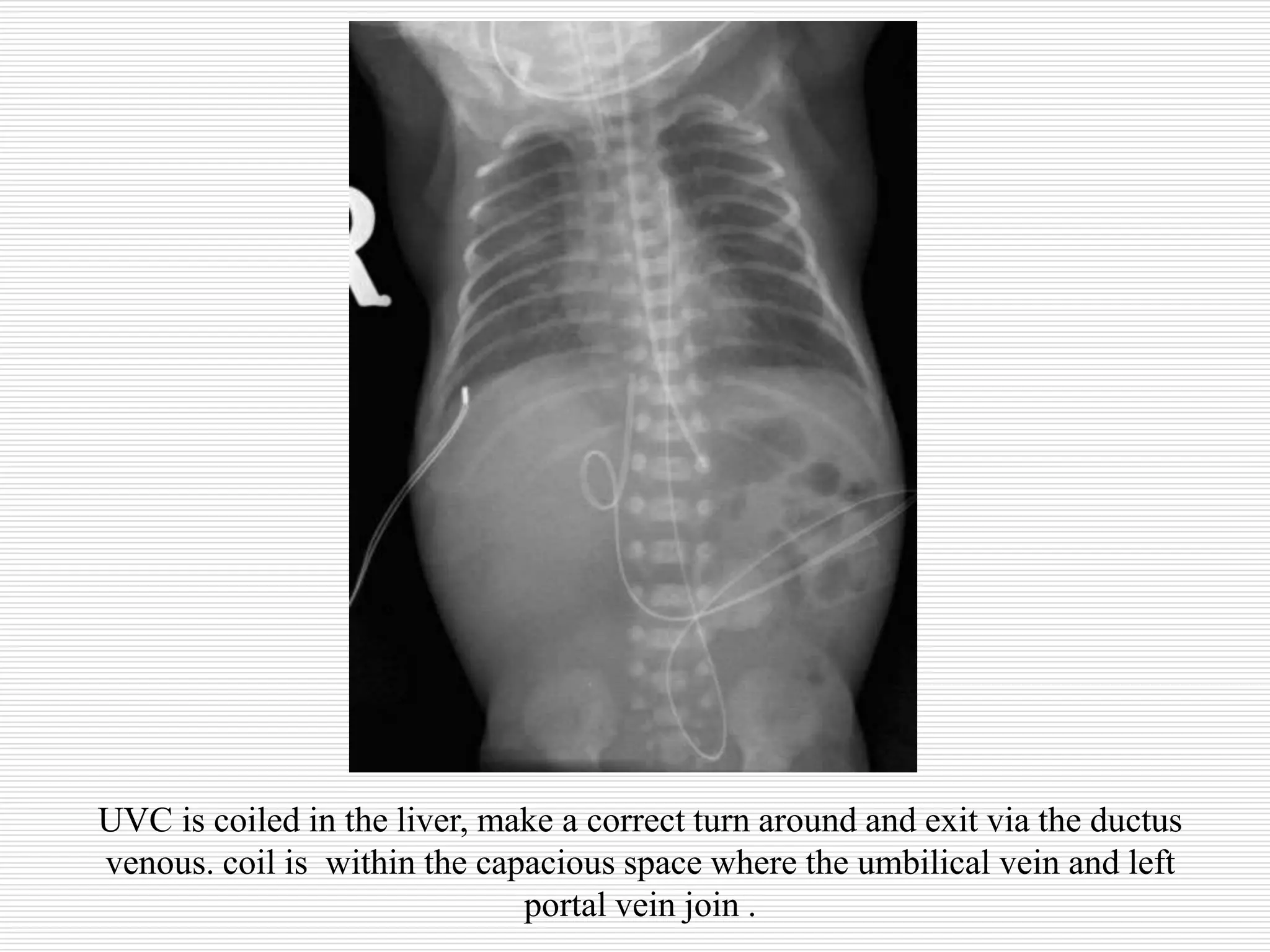 Neonatal Umbilical Venous Catherization Radiology | PPT