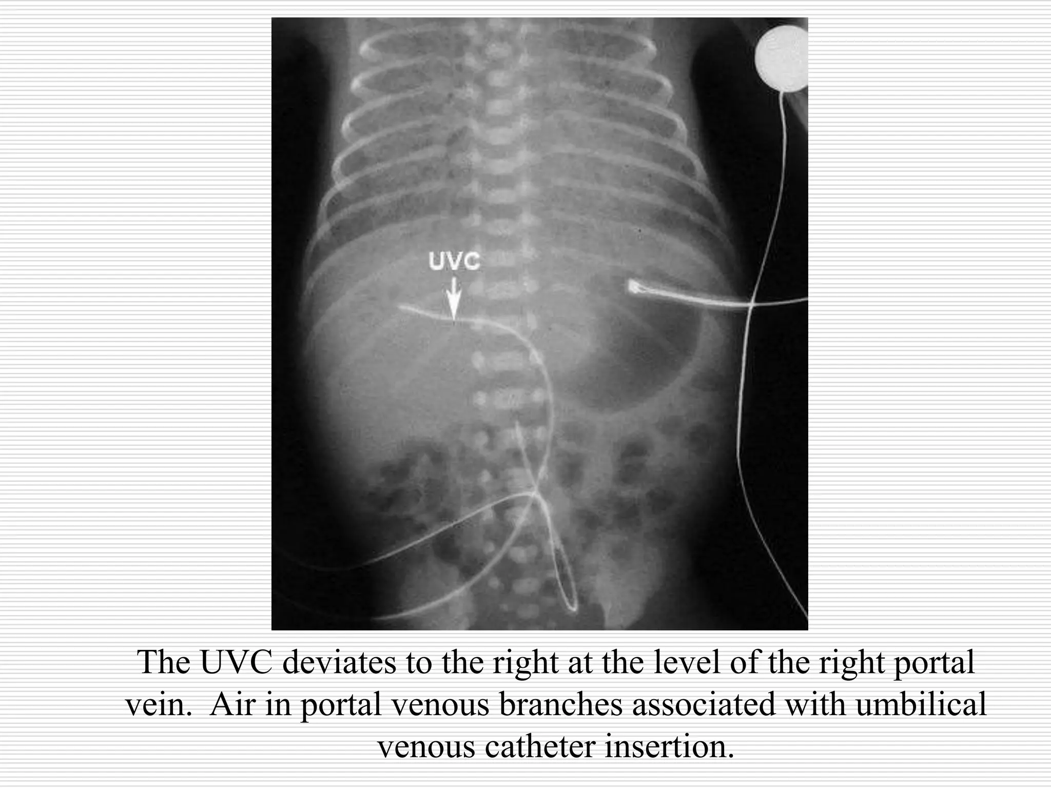 Neonatal Umbilical Venous Catherization Radiology | PPT