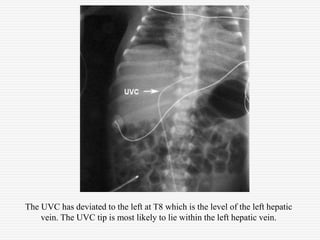 Neonatal Umbilical Venous Catherization Radiology | PPT