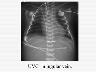 Neonatal Umbilical Venous Catherization Radiology | PPT