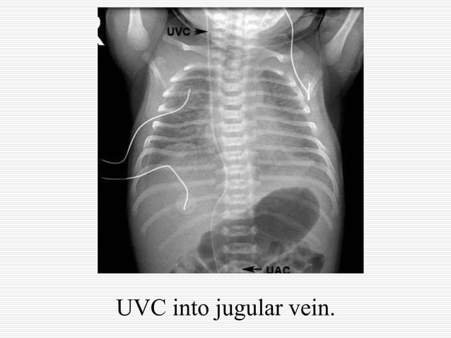 Neonatal Umbilical Venous Catherization Radiology | PPT | Heart and ...