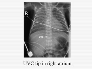 Neonatal Umbilical Venous Catherization Radiology | PPT
