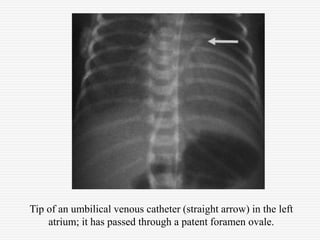 Neonatal Umbilical Venous Catherization Radiology | PPT
