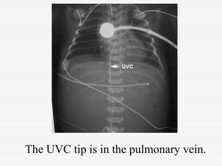 Neonatal Umbilical Venous Catherization Radiology | PPT