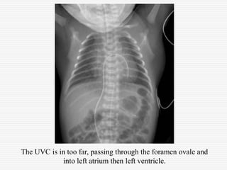 Neonatal Umbilical Venous Catherization Radiology | PPT