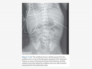 Neonatal Umbilical Venous Catherization Radiology | PPT