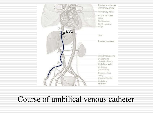 Neonatal Umbilical Venous Catherization Radiology | PPT | Heart and ...