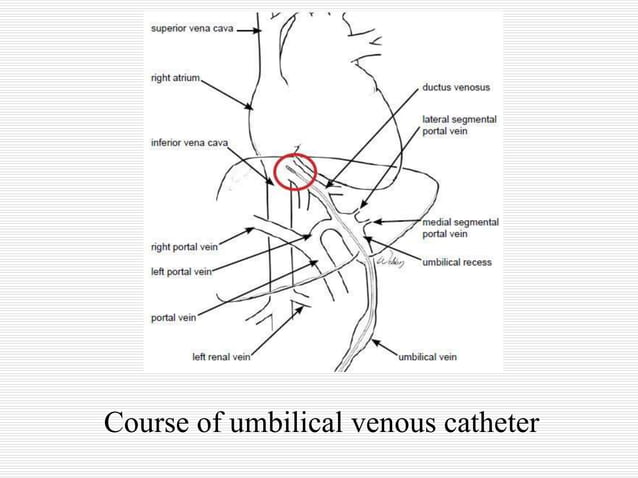Neonatal Umbilical Venous Catherization Radiology | PPT | Heart and ...