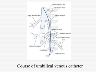 Neonatal Umbilical Venous Catherization Radiology | PPT