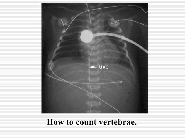 Neonatal Umbilical Venous Catherization Radiology | PPT | Heart and ...