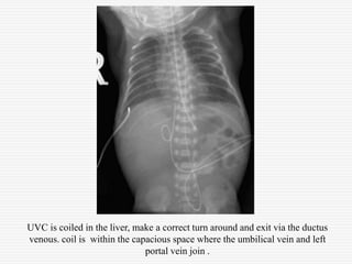 Neonatal Umbilical Venous Catherization Radiology | PPT