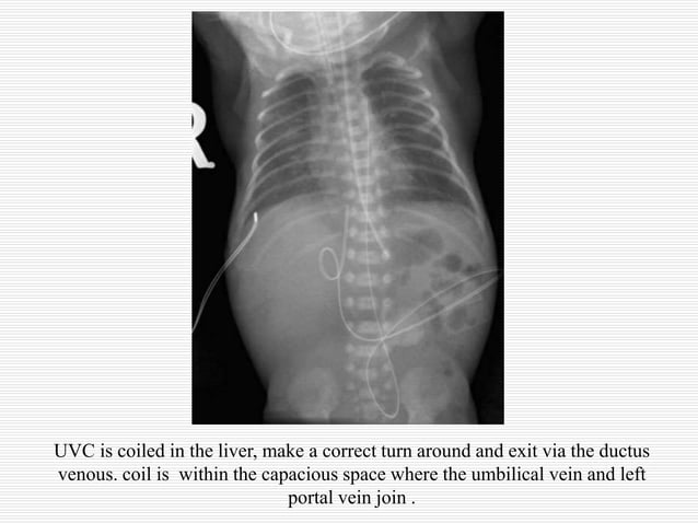 Neonatal Umbilical Venous Catherization Radiology | PPT | Heart and ...